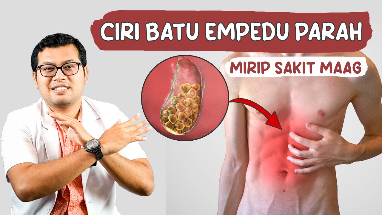 TANDA SAKIT BATU EMPEDU YANG PARAH - DOKTER SADDAM ISMAIL - YouTube