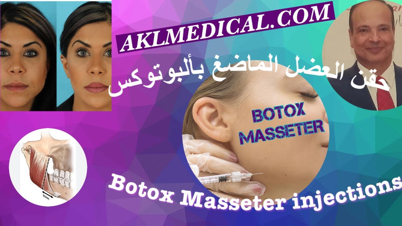 Masseter Botox injections arabic - YouTube