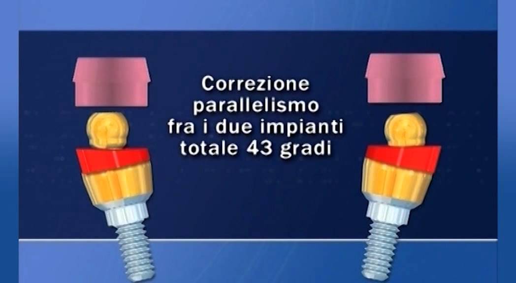 Rhein 83 Overdenture Sphero Flex Sphero Block_ITA - YouTube