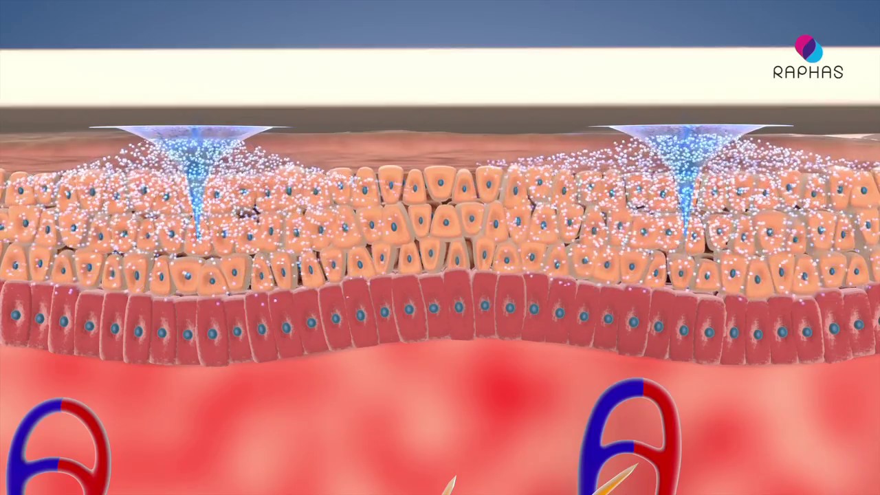 How micro-cone gets absorbed into skin? 마이크로콘패치 흡수 모습 - YouTube