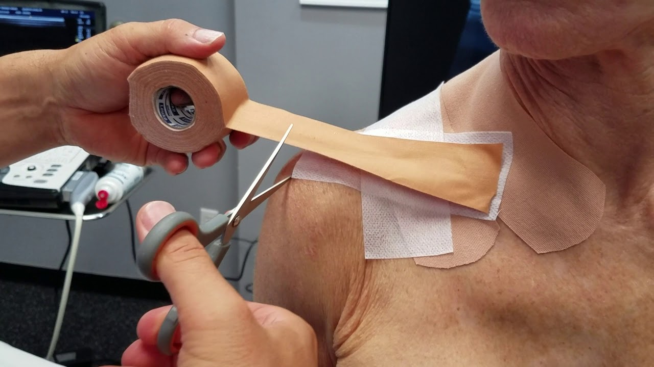 A C Acromioclavicular Joint Taping YouTube a-c-acromioclavicular-joint-taping-youtube