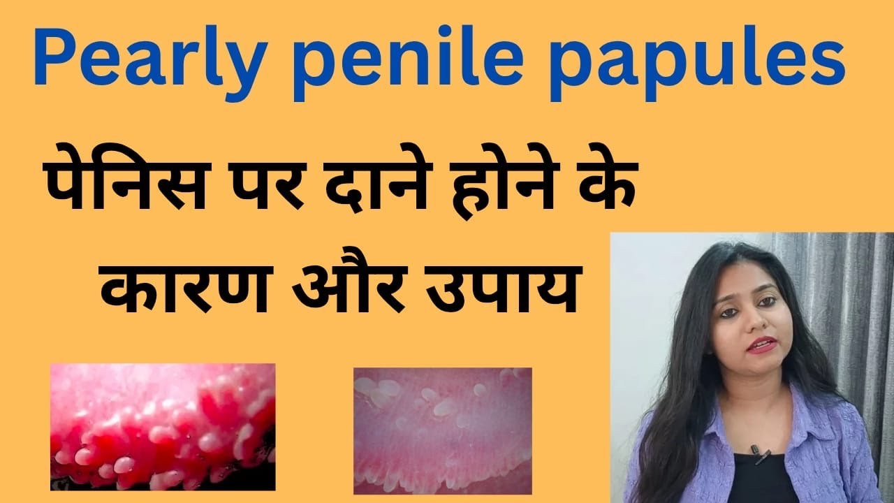 Pearly penile papules treatment without surgery !! PPP symptoms, causes ...
