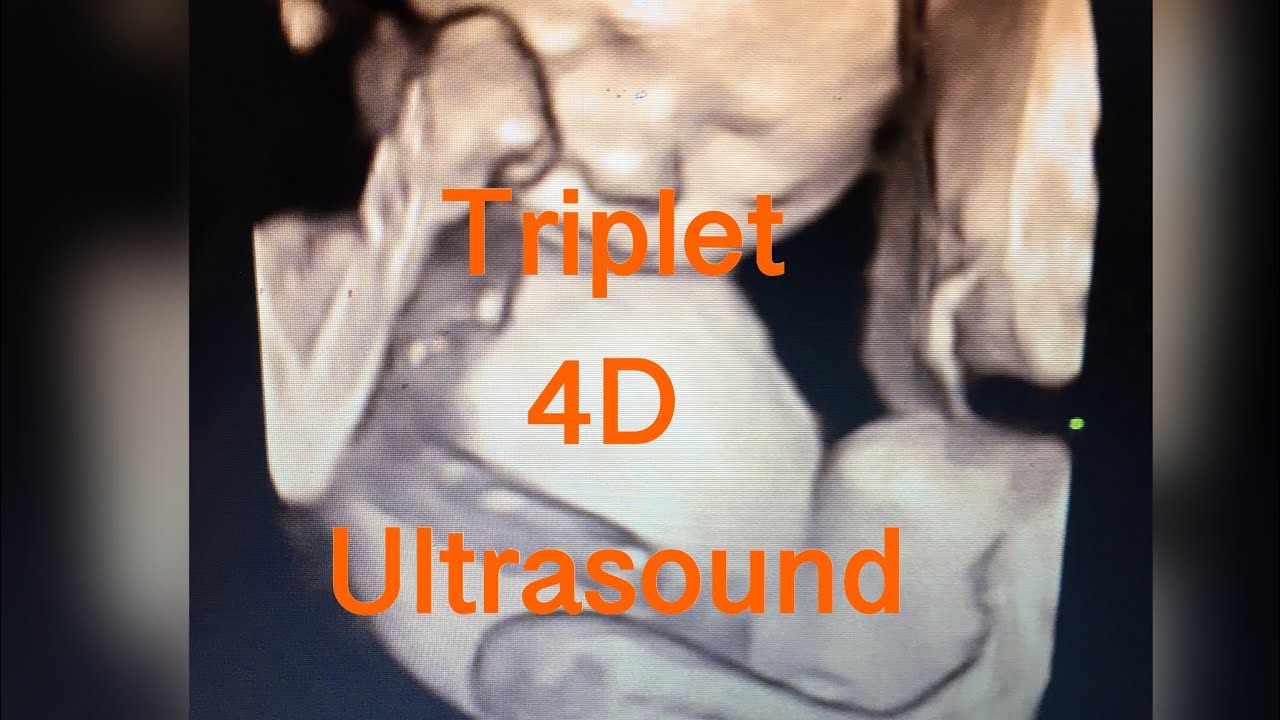 Triplet 4D ultrasound pictures - YouTube