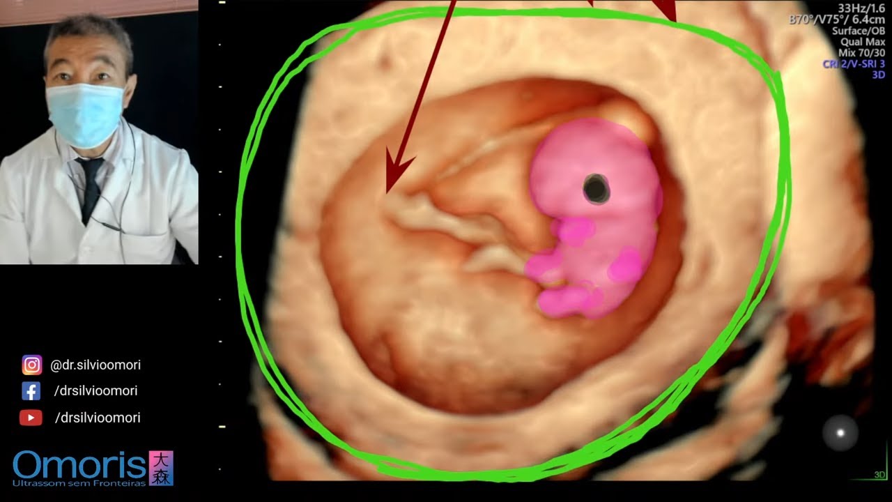 Gestação 9 semanas - YouTube