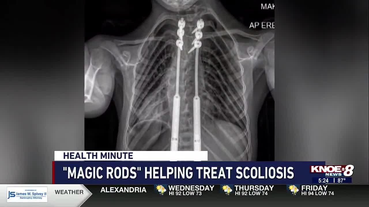 "Magic Rods" helping treat scoliosis - YouTube