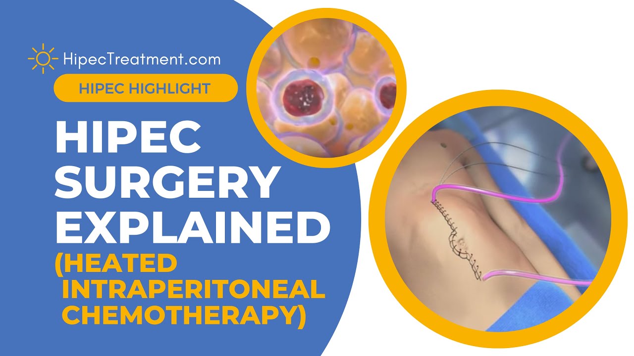 Hipec Treatment Explanation | HipecTreatment.com - YouTube