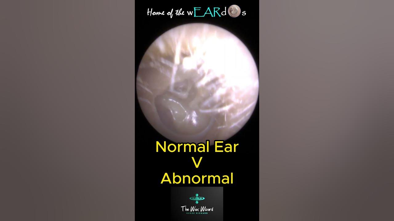 Normal V Abnormal Ear facinating ear earcare YouTube normal-v-abnormal-ear-facinating-ear-earcare-youtube