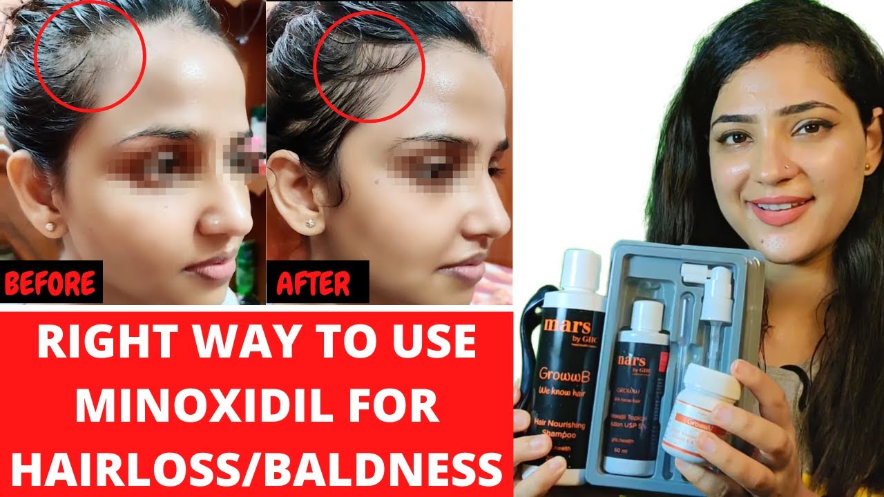 Minoxidil for hair regrowth, hair loss | Minoxidil Journey 4 MONTHS ...