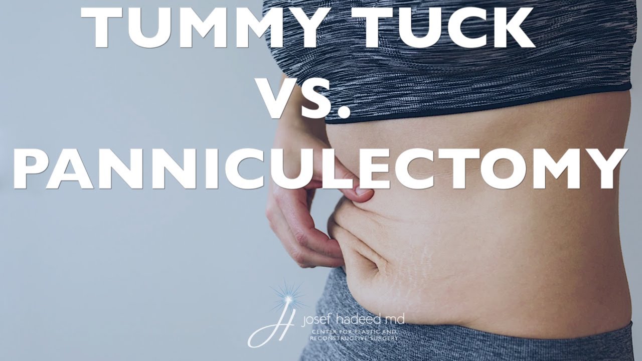 Tummy Tuck vs Panniculectomy - YouTube