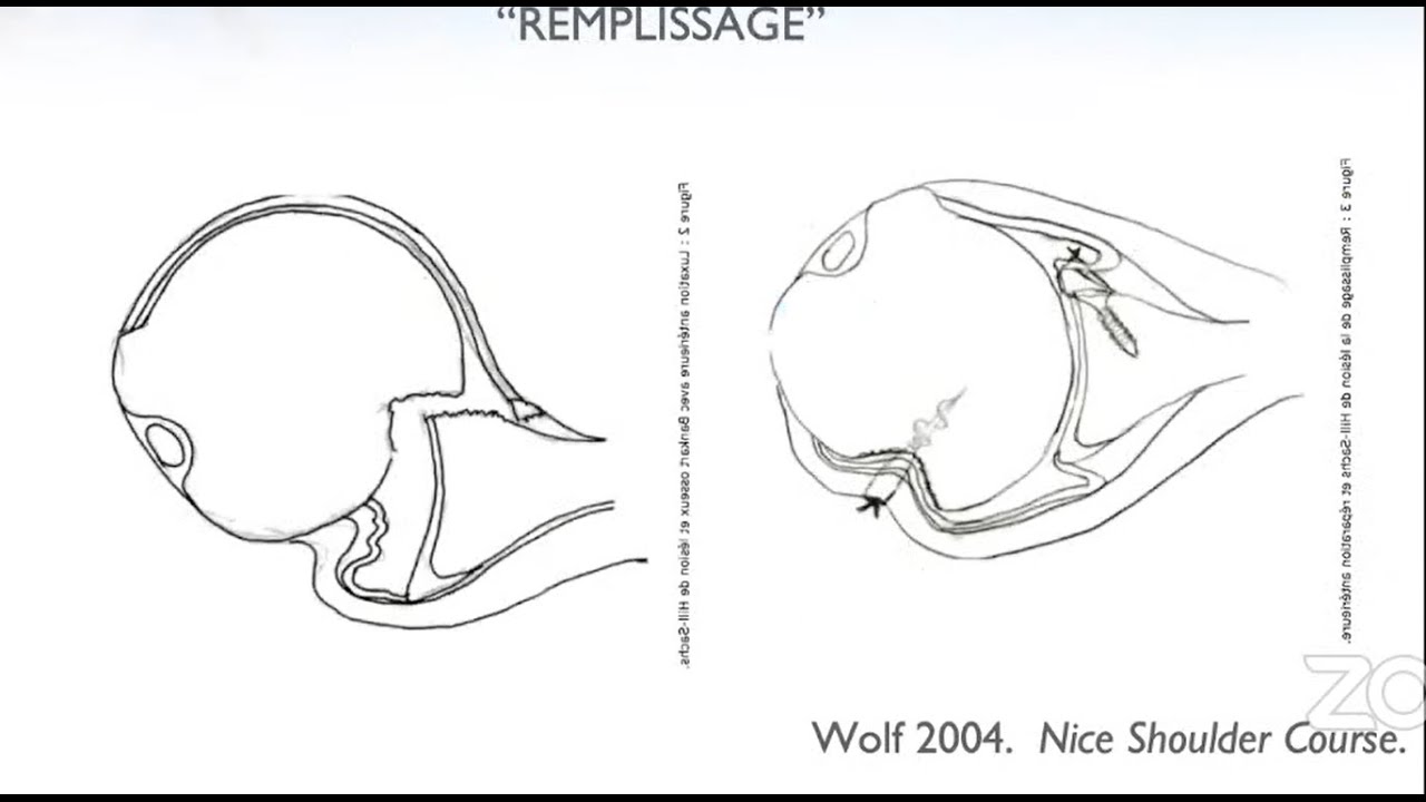 Remplissage: Should we take it seriously #ASESPresident - YouTube