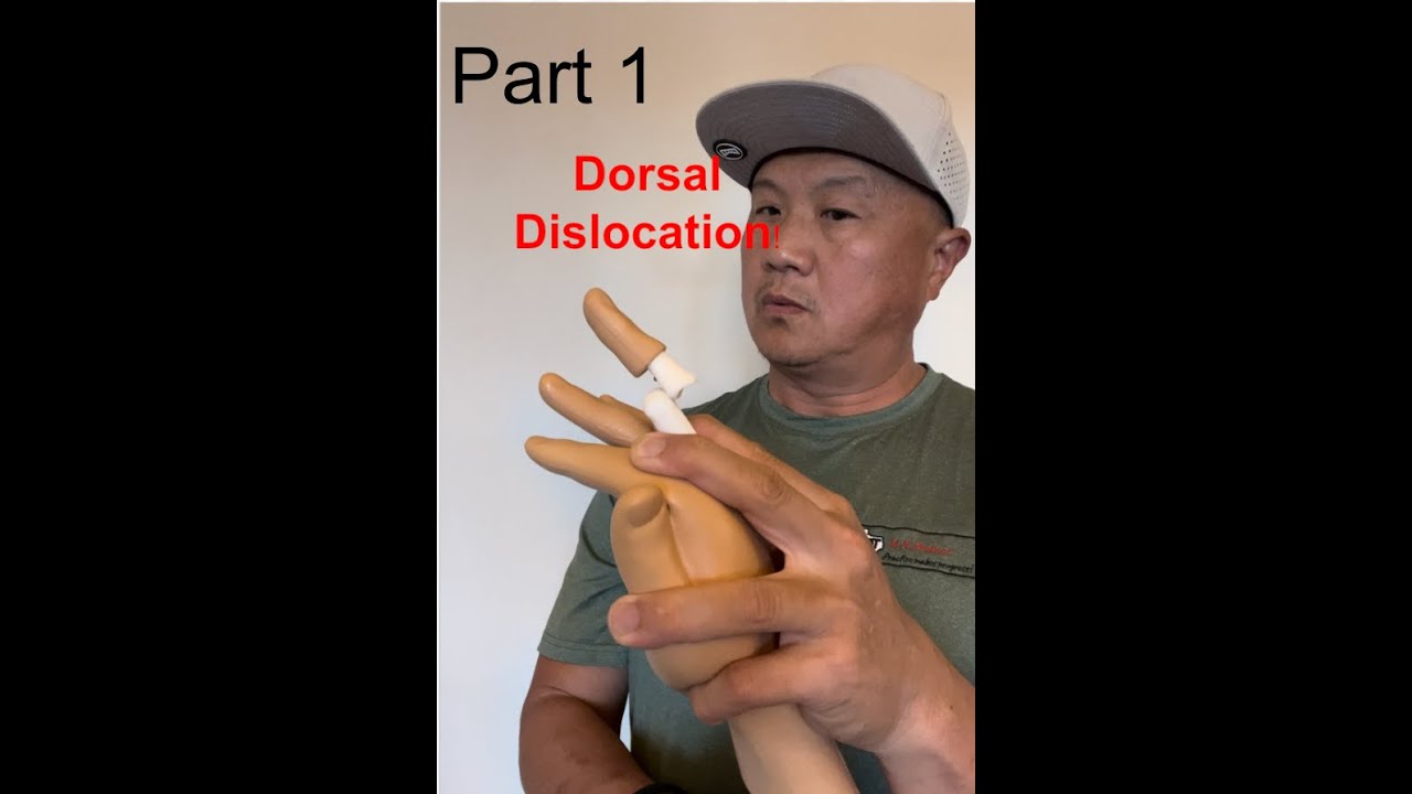 Dorsal Finger Dislocation #1 | Reduction Technique | Sports Medicine | Athletic Training | - YouTube