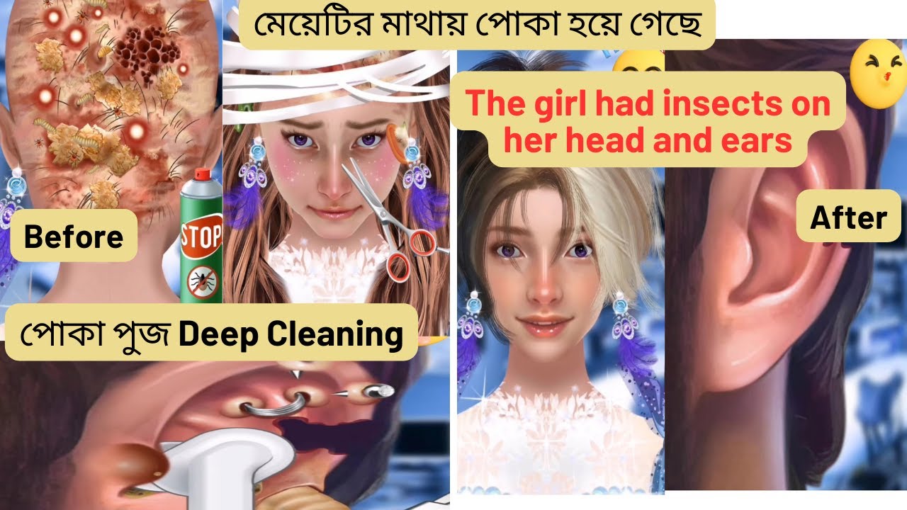 ASMR:মাথা ও কানের পোকা অপসারণ।.How to Safely Remove Insects from the ...