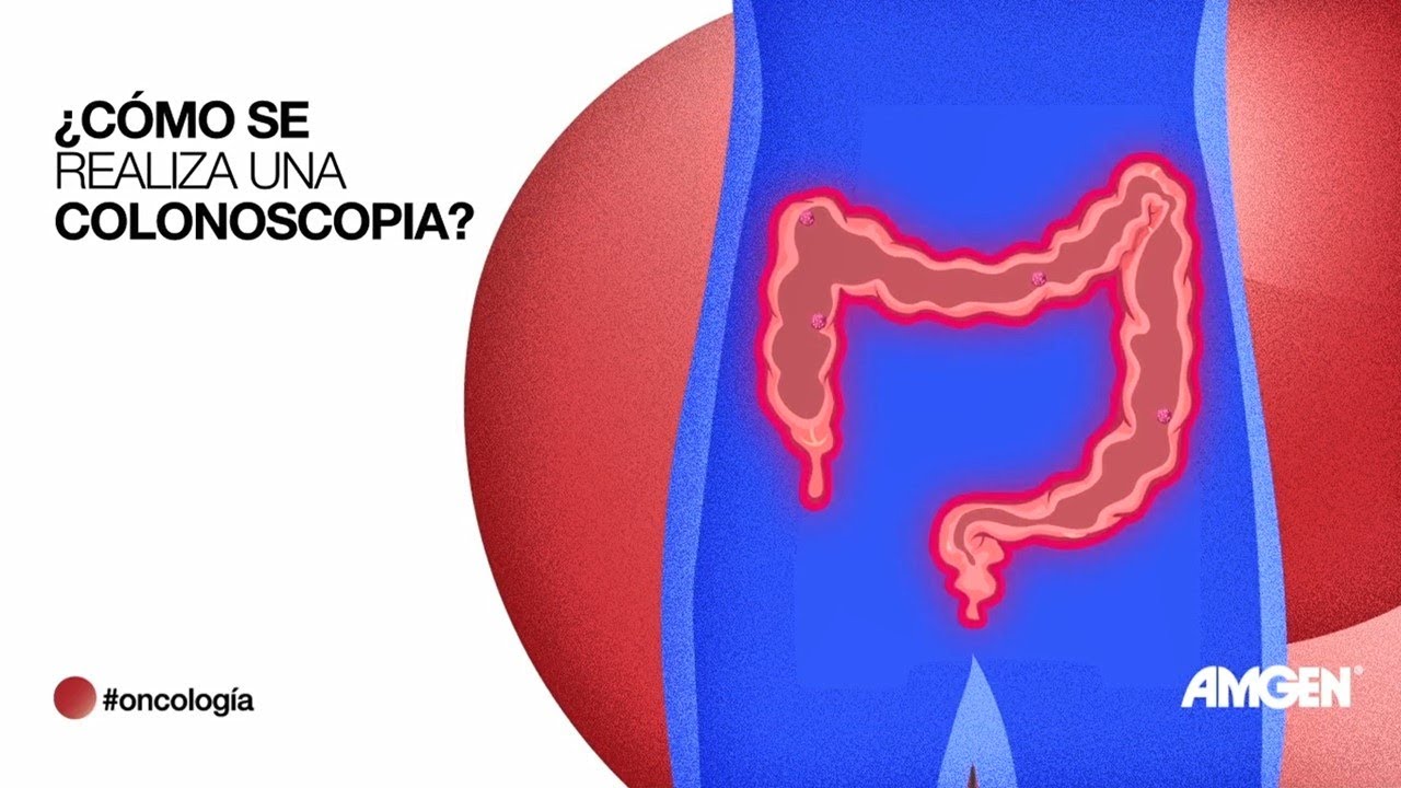 ¿Cómo se realiza una colonoscopia? - YouTube