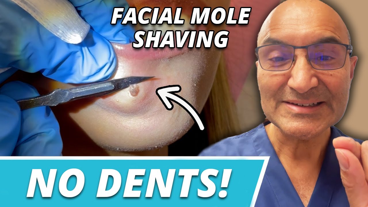 Can Dr. Janjua shave this facial mole without leaving a dent? - YouTube