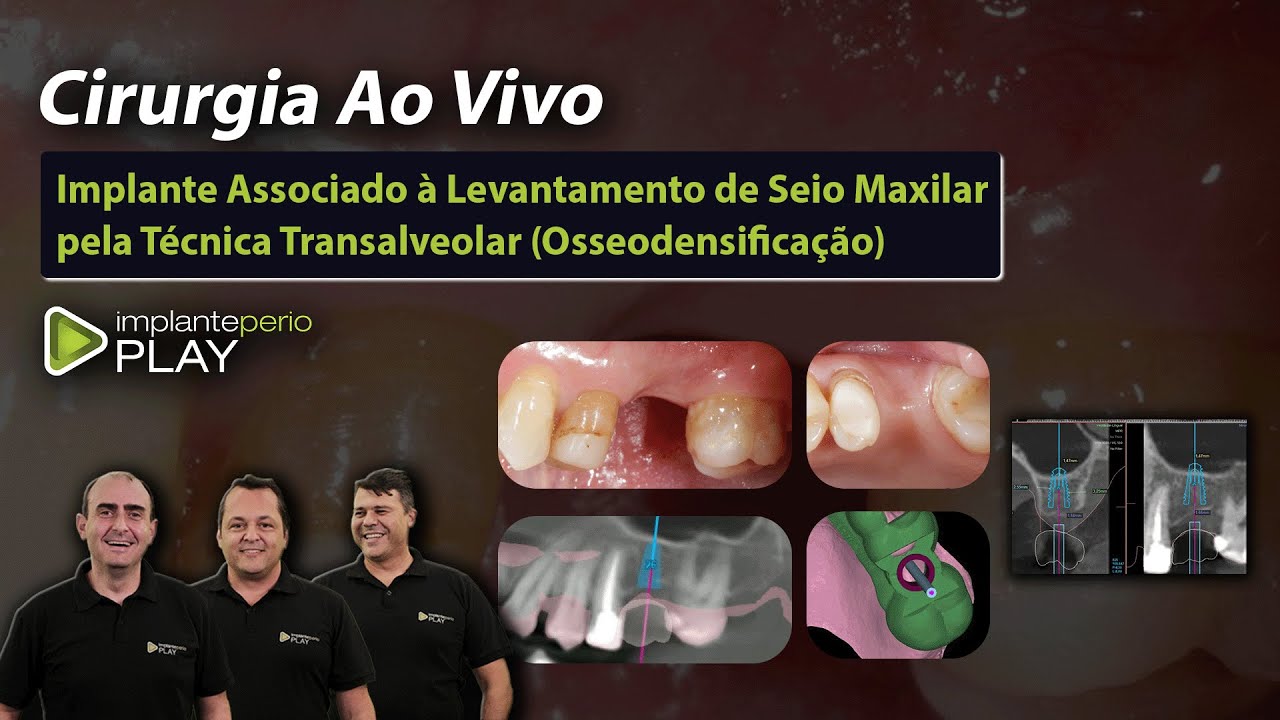 Cirurgia Ao Vivo: Implante Associado à Levantamento de Seio Maxilar ...