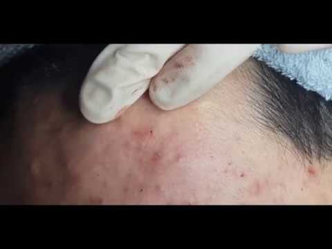 acne removal, extraction - YouTube