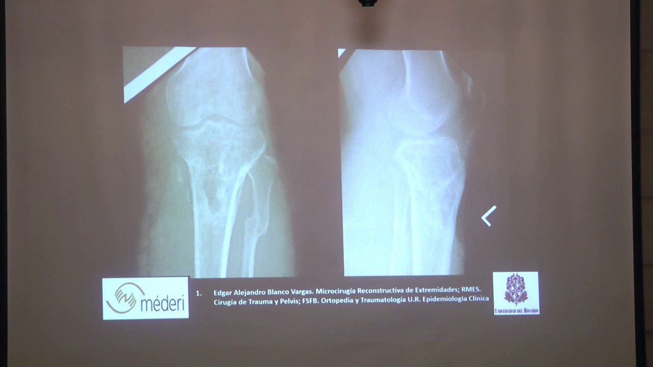 Casos clínicos usando BonAlive - Dr. Alejandro Blanco - YouTube