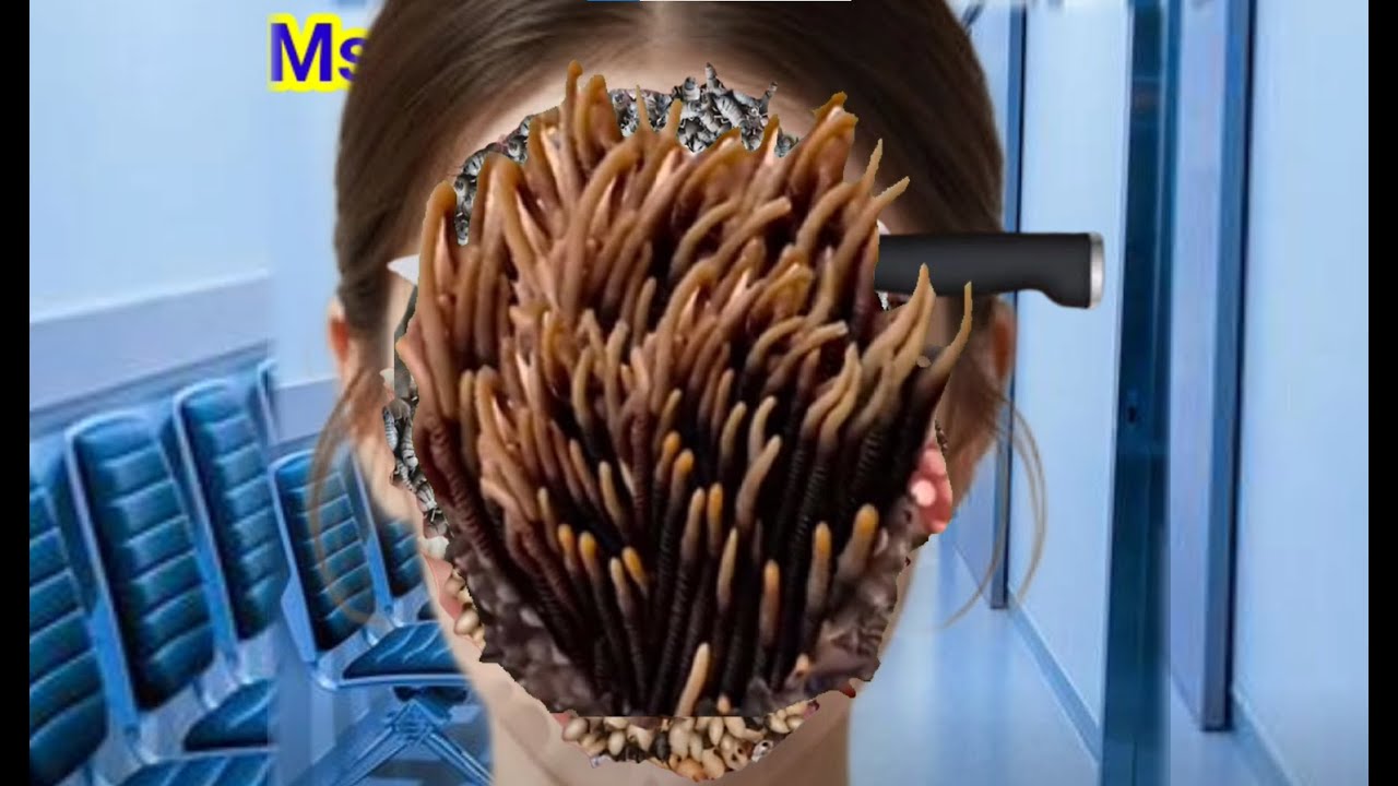 Maggot infection,giant face | asmr girl face maggots removal video | asmr treatment @MsSakir35 ...