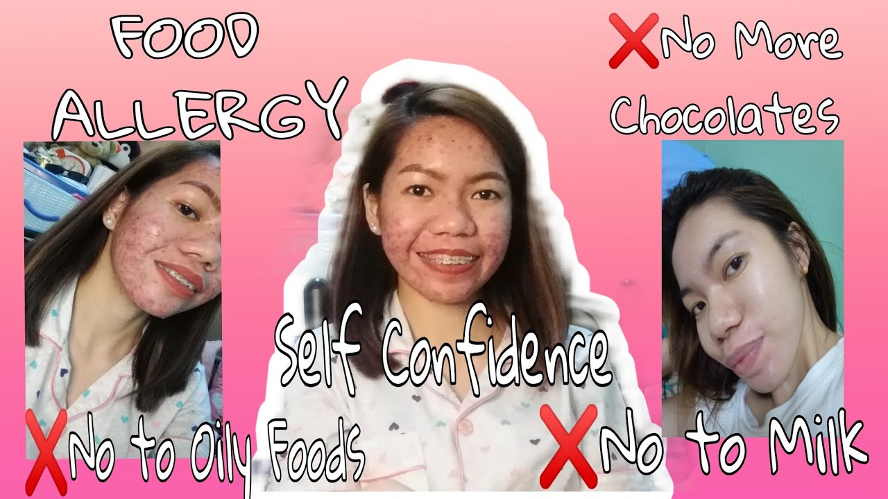 ANONG NANGYARI SA MUKHA KO?? FOOD ALLERGY?? - YouTube