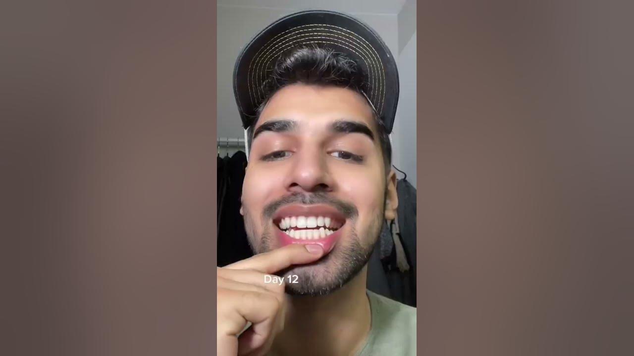 Trying A Crest Whitening Strips For 20 Days selfcare YouTube trying-a-crest-whitening-strips-for-20-days-selfcare-youtube
