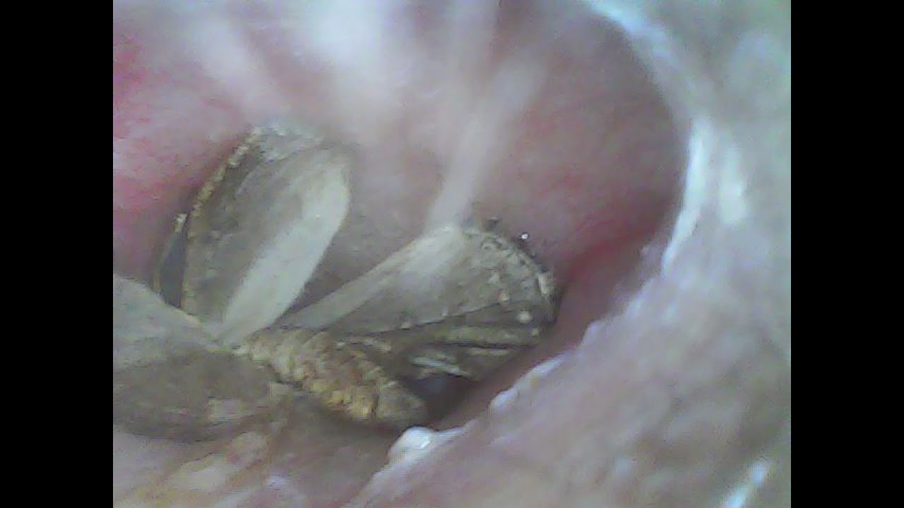 Live Insect in the Ear...!! Endoscopic removal - YouTube