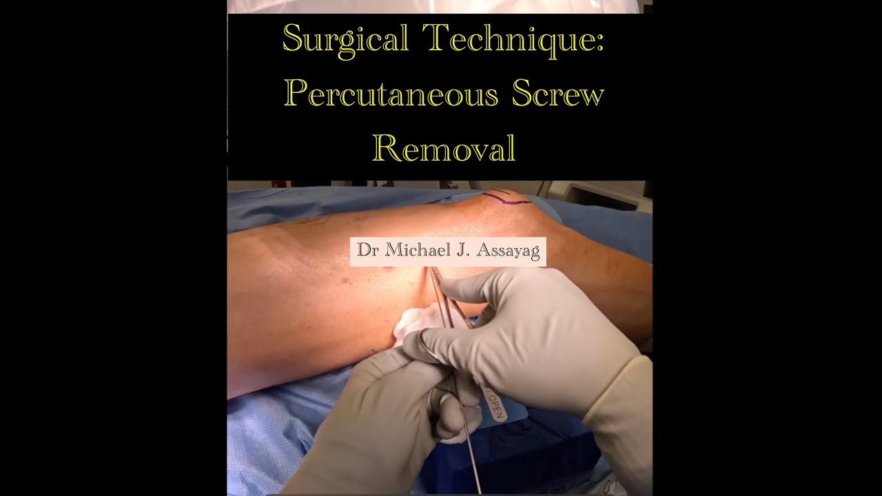 Surgical Technique: Percutaneous Screw/Peg Removal from a PRECICE 2.2 ...