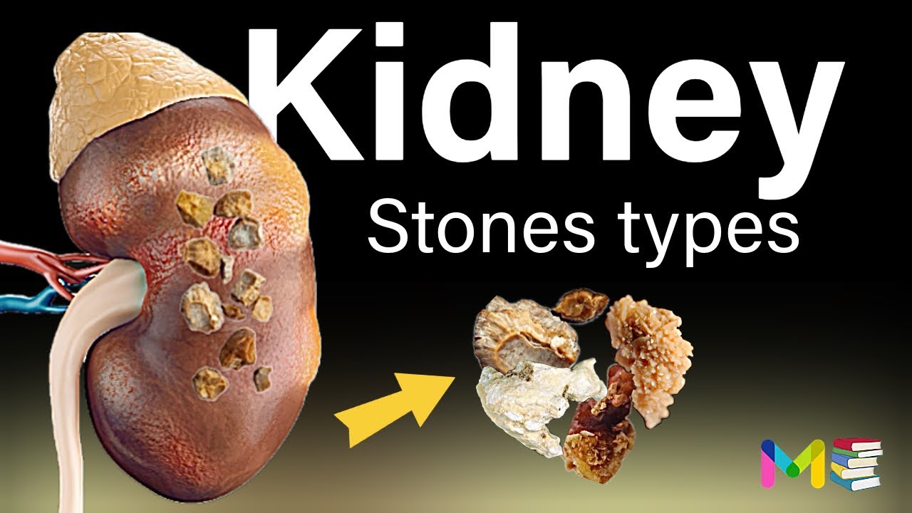 TYPES OF KIDNEY STONES - YouTube