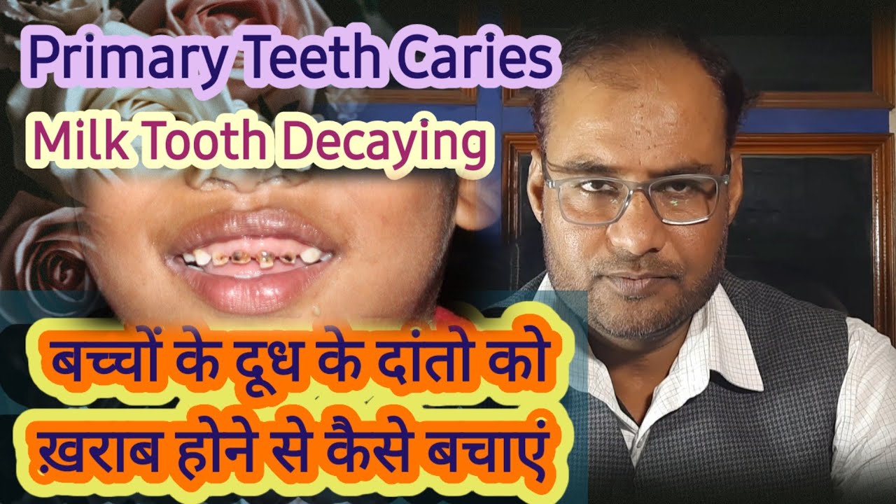 #Primary teeth caries#Milk teeth cavity#Caries on Deciduous teeth#दूध के दांतो की सड़न#dental# ...