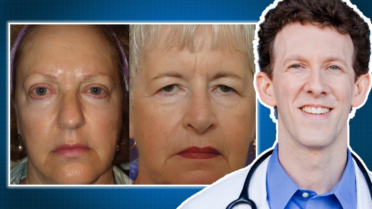 Doctor Explains What is a "Resting Bitchy Face" - YouTube