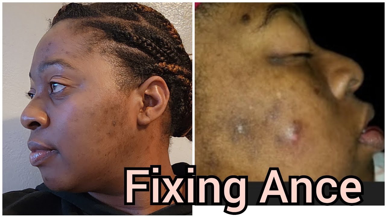 How I Fix My Ance | Getting Healthy Skin | Update - YouTube