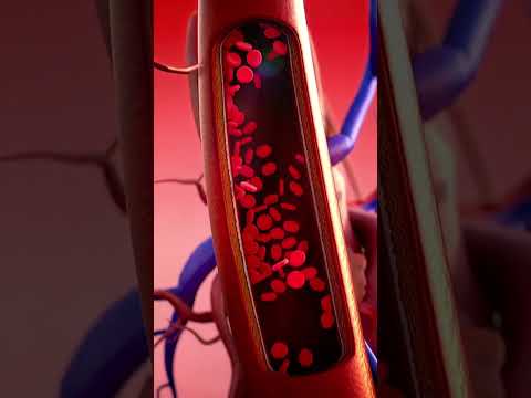 HIPERTENSIÓN ARTERIAL 