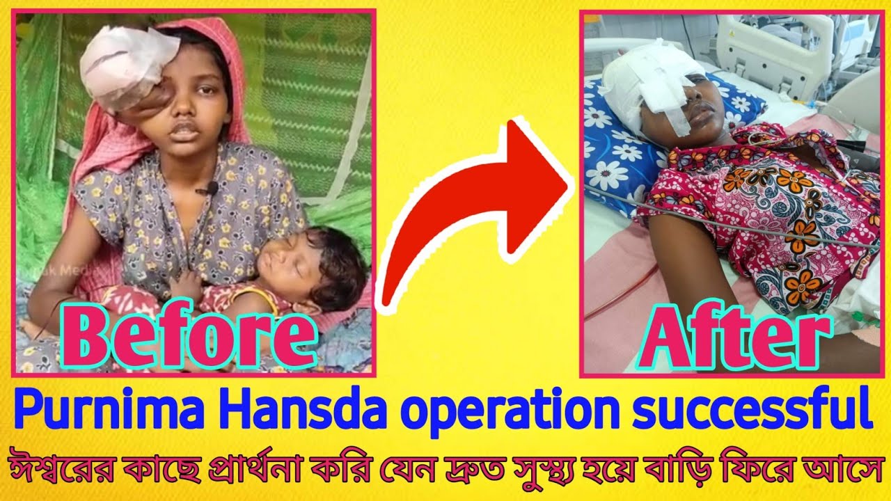 Purnima Hansda operation successful||Santali Update Boy - YouTube