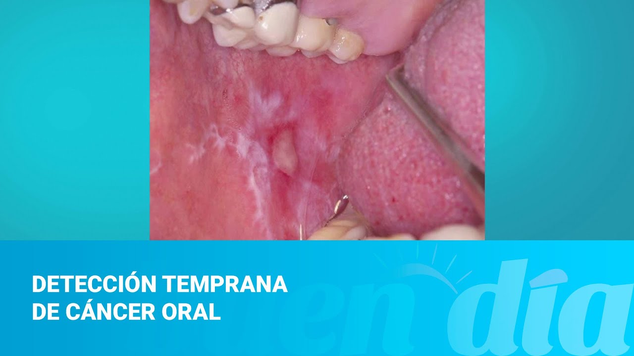 Detección temprana de cáncer oral - YouTube