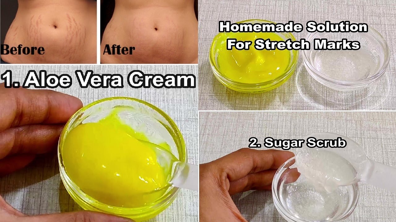 Erase Stretch Marks in 4 weeks | Home Remedies to Remove Stretch Marks ...