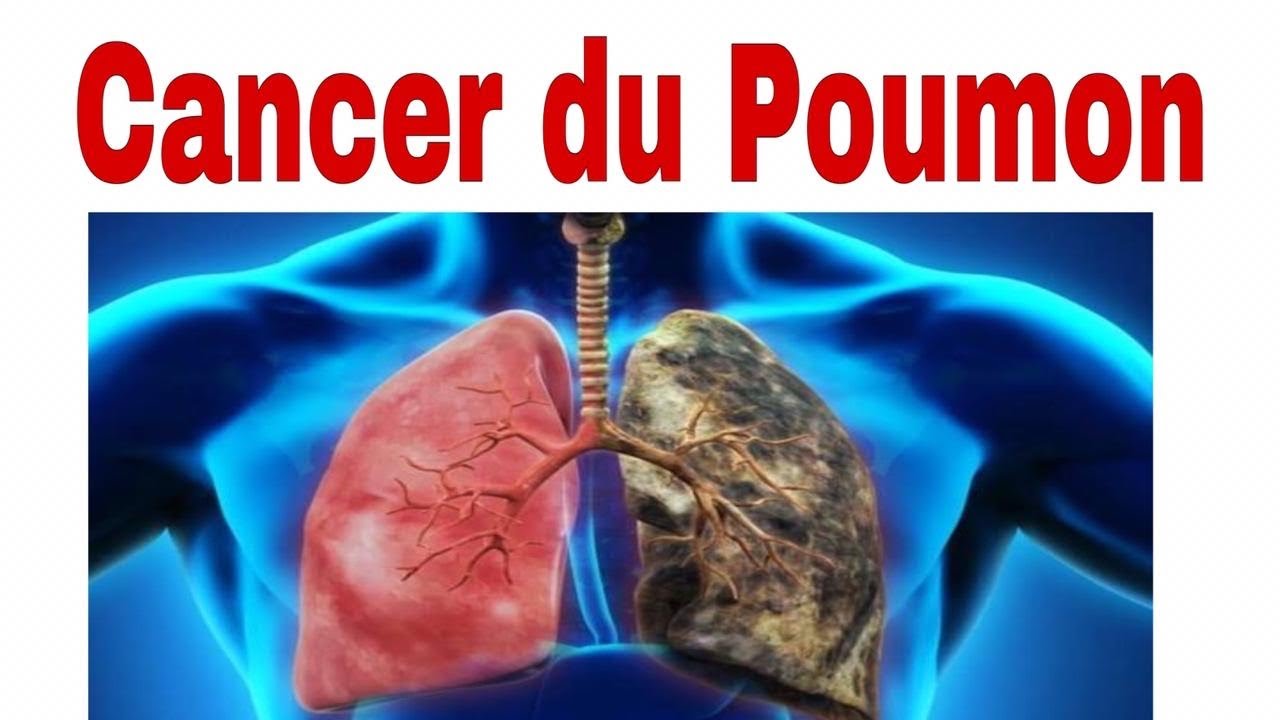 Cancer du poumon 🚬 - YouTube