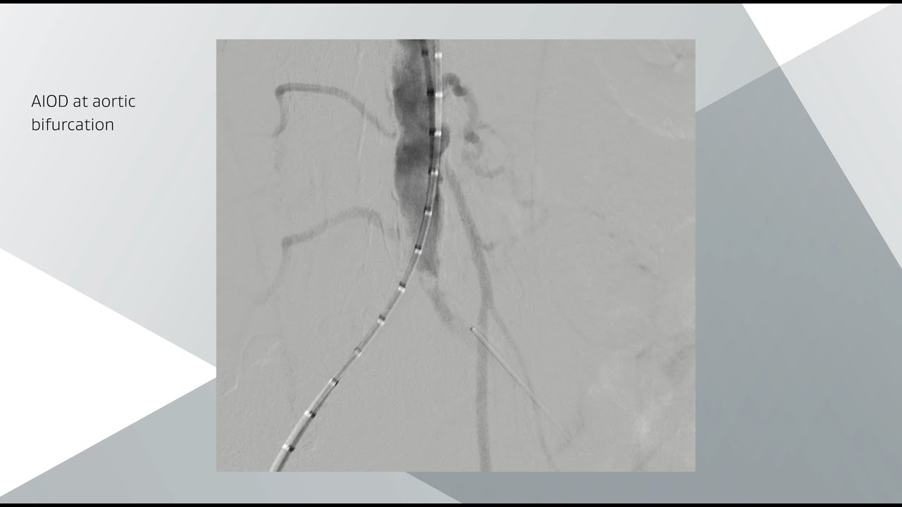 Case Study: Treating Severe Aortoiliac Occlusive Disease (AIOD) at the ...