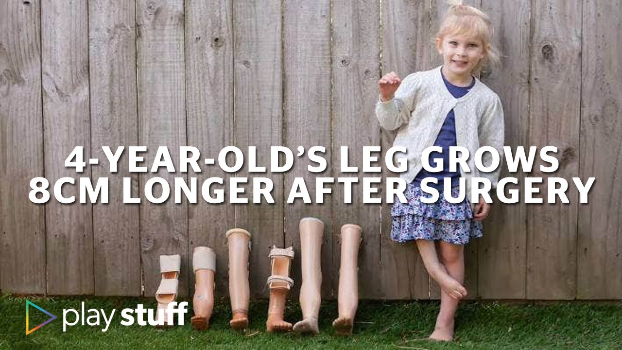 4-year-old's leg grows 8cm longer after surgery | KEA Kids News | Stuff ...