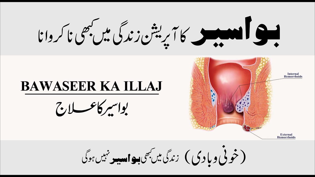 Bawaseer ka nuskha | Bawaseer Ka Ilaj | Bawaseer Ka Capsule | - YouTube