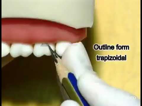 Class V cavity preparation - YouTube