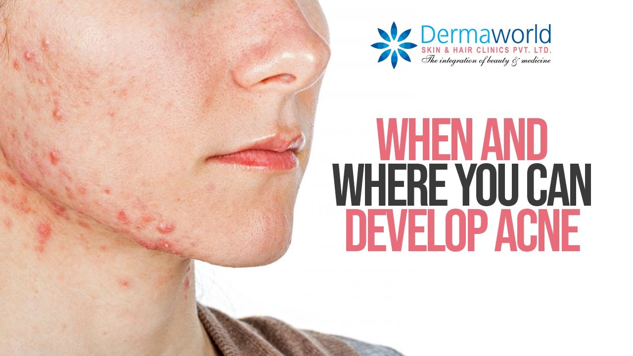When and where you can develop an Acne or pimple | Cures for your acne ...