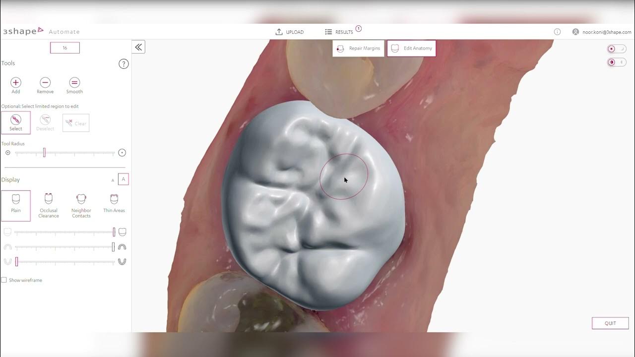 3Shape Automate - upload case Dental System, design, review, edit, accept - YouTube