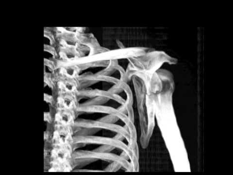 My broken scapula (shoulder blade) - YouTube