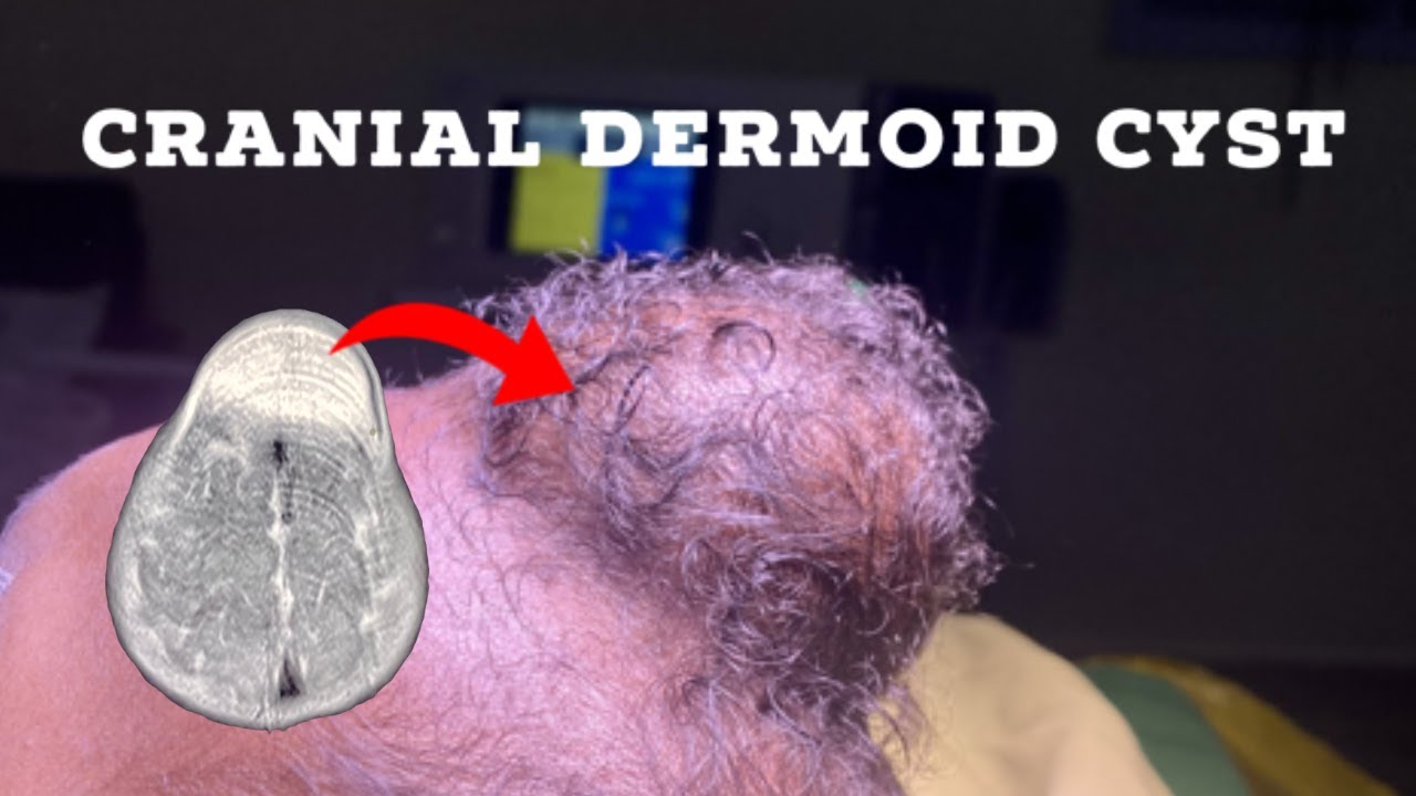 Cranial Dermoid Cyst - YouTube