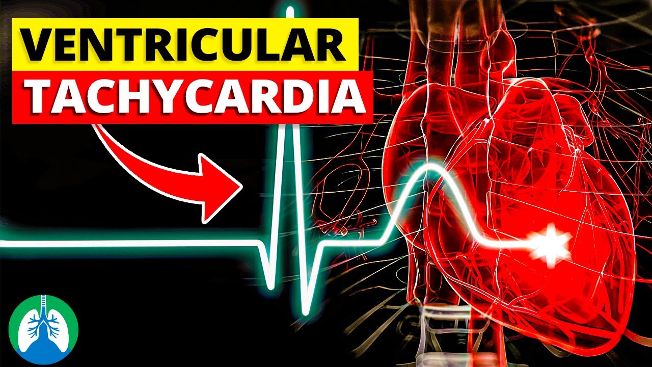 Ventricular Tachycardia (V-tach) | Medical Explainer Video - YouTube