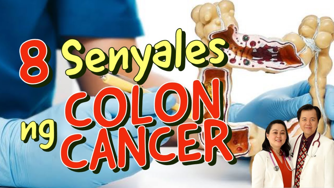 8 Senyales ng Colon Cancer - Payo ni Doc Willie Ong - YouTube