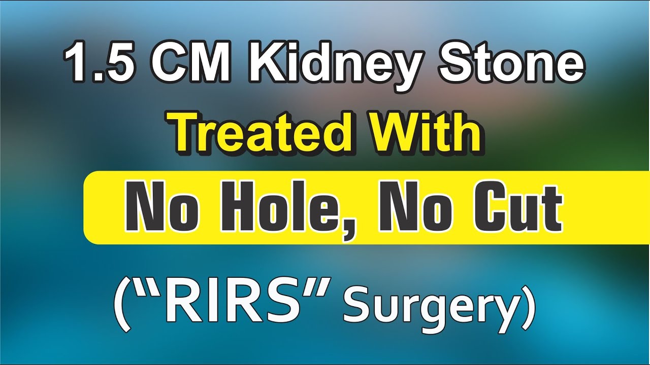 1 5 Cm Kidney Stone Treated With No Hole No Cut Procedure YouTube