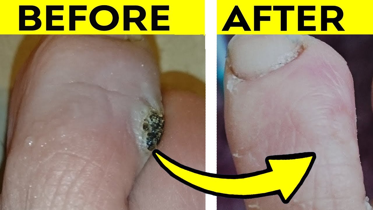 How to Get Rid of the Worst Wart Naturally - YouTube