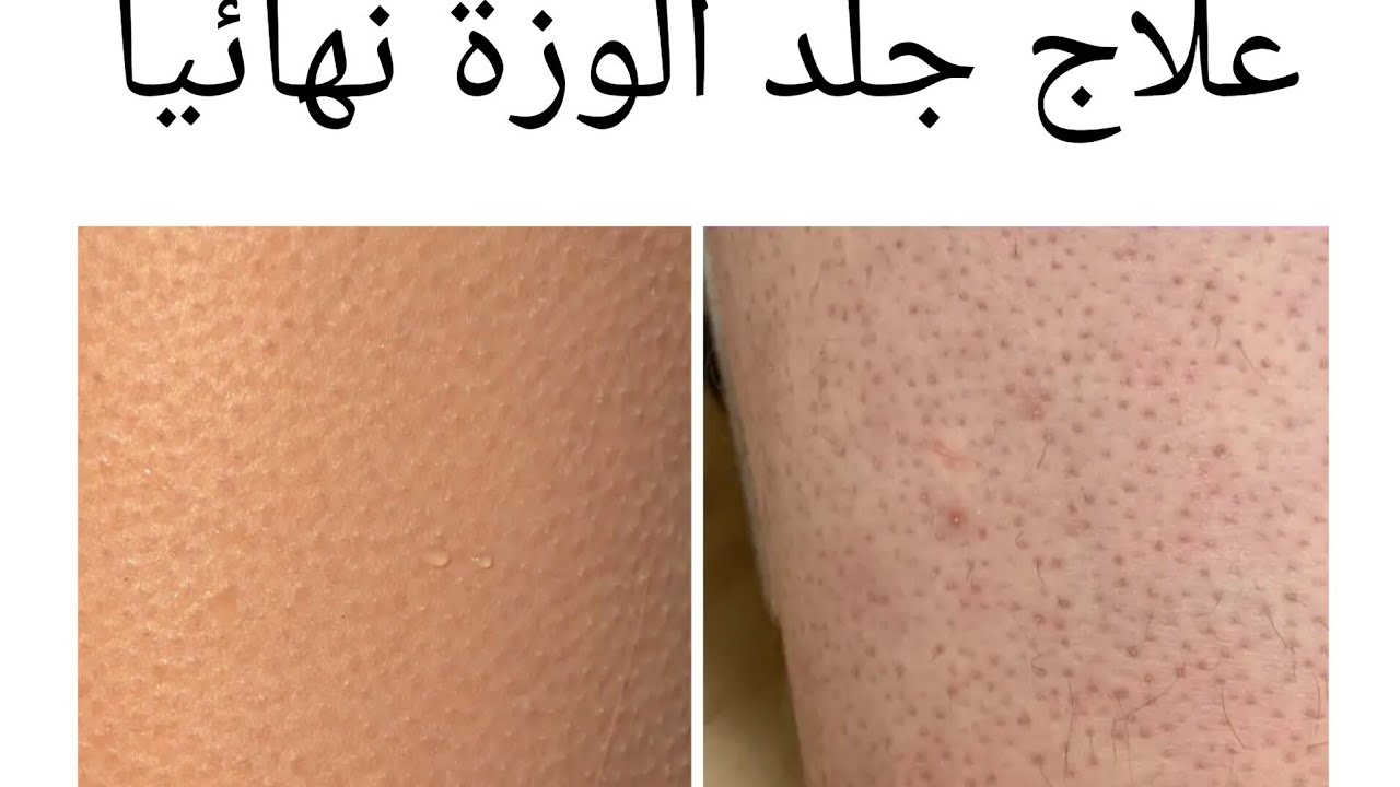 التخلص من جلد الدجاجة التخلص من جلد الوزةنمو الشعر تحت الجلد Youtube