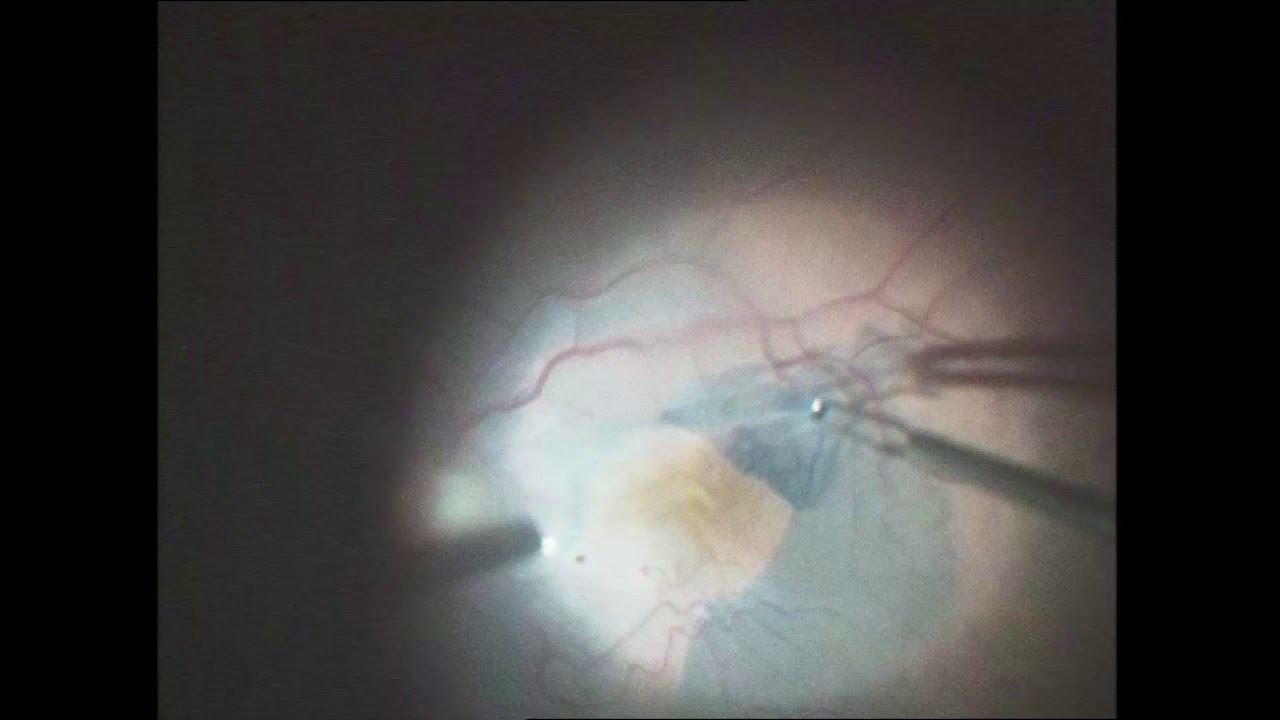 Epiretinal Membrane Surgery | ERM | Internal Limiting Membrane Peeling ...