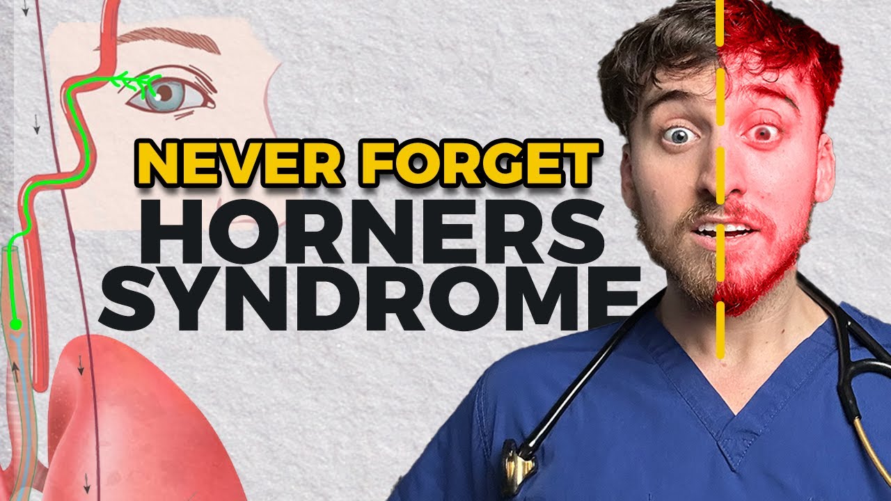 Horner’s Syndrome: Everything You Need to Know (and how to remember it ...